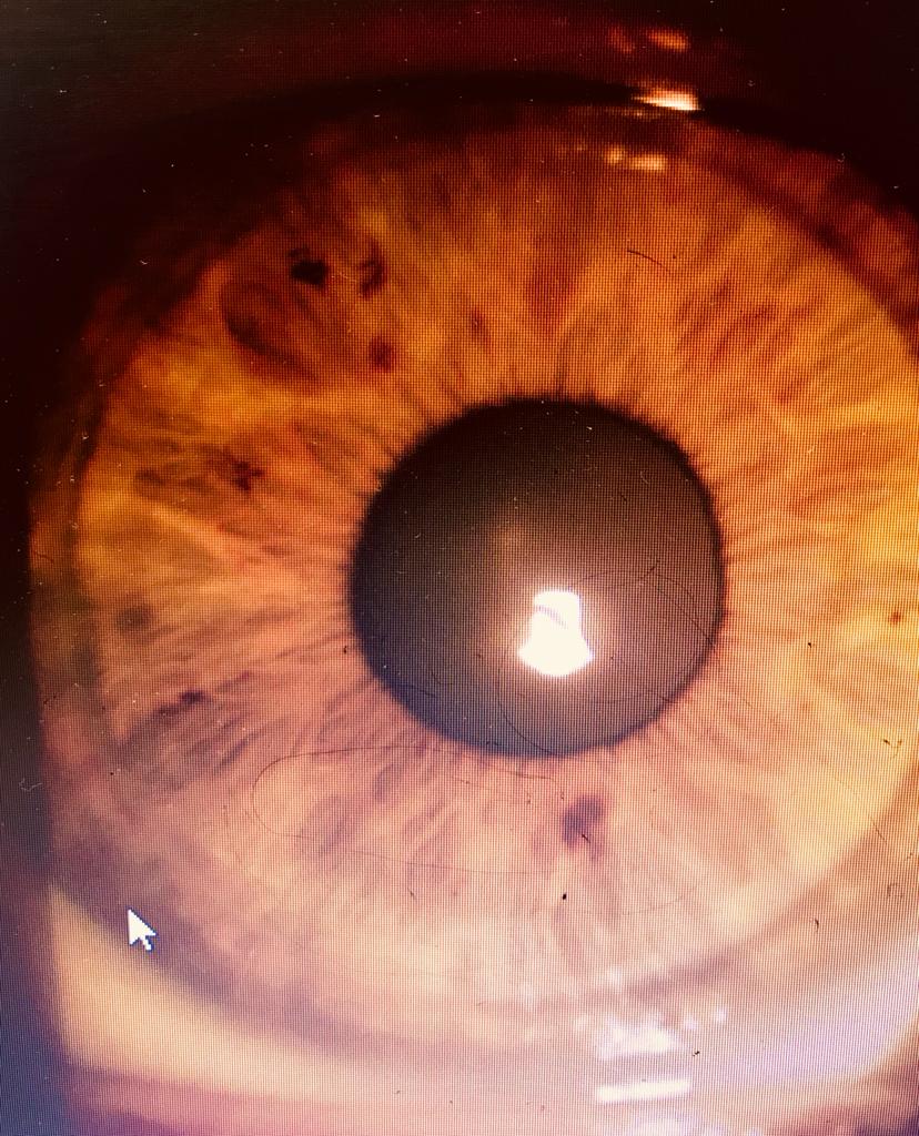 C. Corneal Transplant after Removal of Sutures