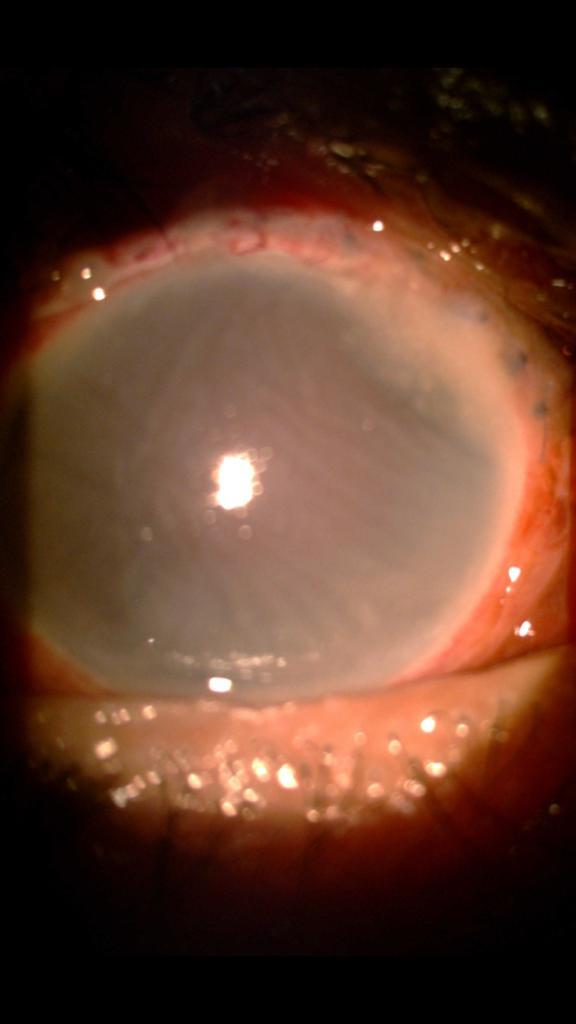 A. Diseased Cornea
